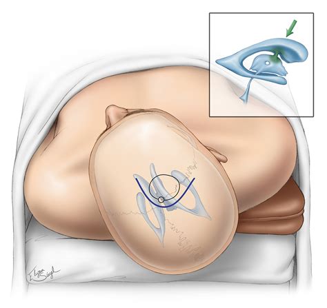 Principles Of Intraventricular Surgery Cohen Collection Volumes