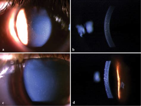 Fleck Corneal Dystrophy