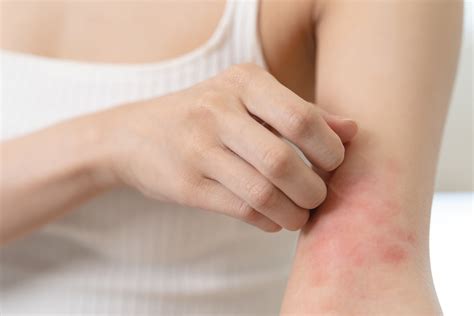 Post Viral Rashes Causes Symptoms And When To Get Help