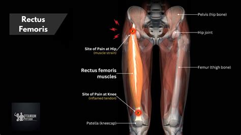 Rectus Femoris Strain Advancing Recovery By Incorporating