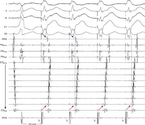 Typical Atrioventricular Bypass Tracts Thoracic Key