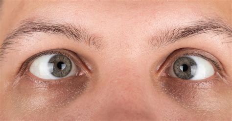 Botox And Strabismus Understanding The Connection Allbotox