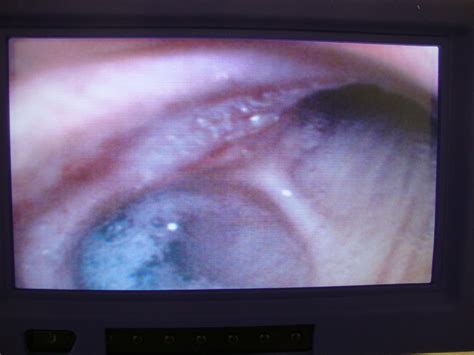 Visual Confirmation Of Correct Placement Of The Bronchial Blocker In