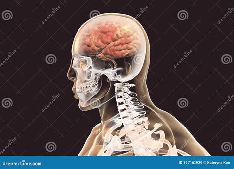 Encephalitis Concept Illustration Showing Edema And Hemorrhages In