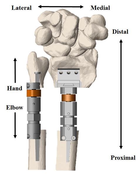 1 Computer Assisted Drawing Of Implanted Experimental Devices Two