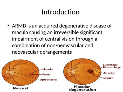 Age Related Macular Degeneration Armd Pptx