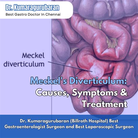 Learn About Meckels Diverticulum Its Causes Symptoms And Treatment Options Insights From