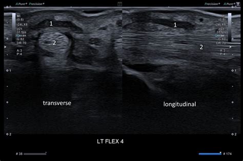 Fibroma Of Tendon Sheath Ultrasound