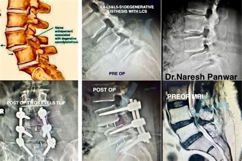Dr Naresh Panwar Mbbs Ms Mch Neurosurgery On Linkedin Celebrating The