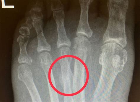 Stress Fracture X Ray At Minh Boser Blog