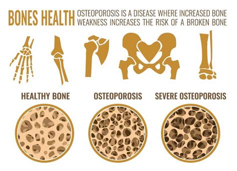 Chiropractic Care As A Treatment For Osteoporosis Northeast Spine