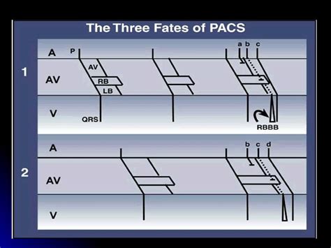 Premature Atrial Complexes Ppt