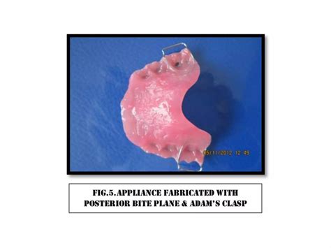 Cross Bite Correction Pptx