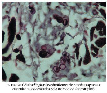 Scielo Brasil Lacaziose Simulando Hanseníase Dimorfa Tuberculóide