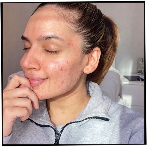Skin Positivity Influencer Kadeeja Khan Shares Her Acne Story