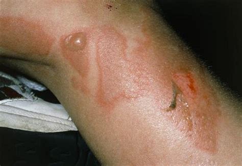 Staphylococcal Scalded Skin Syndrome Dermatologic Disorders Merck Manual Professional Edition