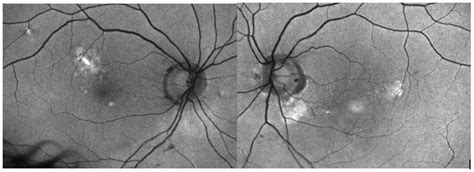 Adult Onset Foveomacular Vitelliform Dystrophy As A Masquerader Of Wet Macular Degeneration