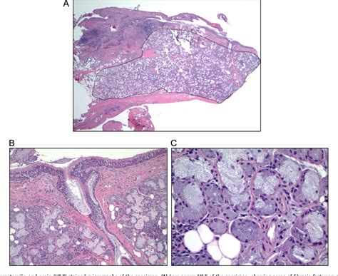 Polyp Of Middle Ear Semantic Scholar