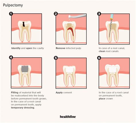 Pulpotomy Pulpectomy Green Park Dental Hospital