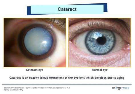 Cataracts Eent Content Blueprint Smarty Pance Panre