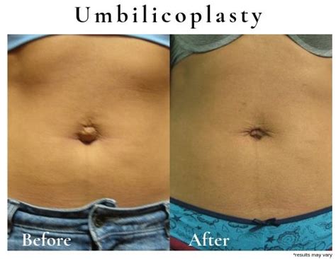 Belly Button Outie To Innie Surgery