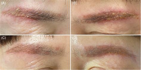 A And B Initial Presentation With Erythema Multiple Small Papules Download Scientific