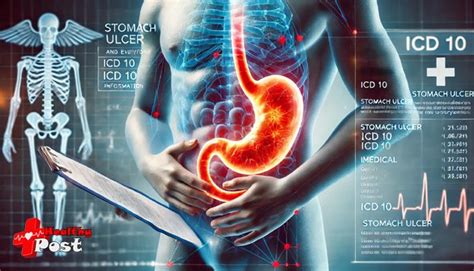 Stomach Ulcer Icd 10 Comprehensive Information