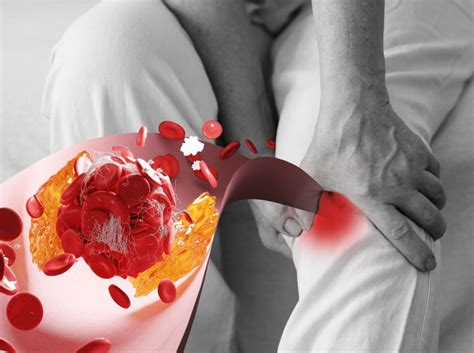 Ateroskleroza I Njena Veza S Bolovima U Leđima