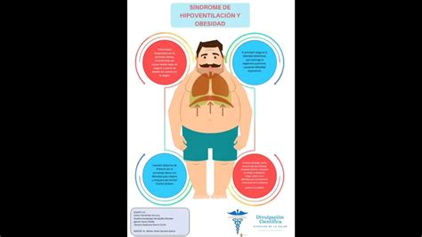 SÍndrome De Pickwick Obesidad E HipoventilaciÓn Youtube