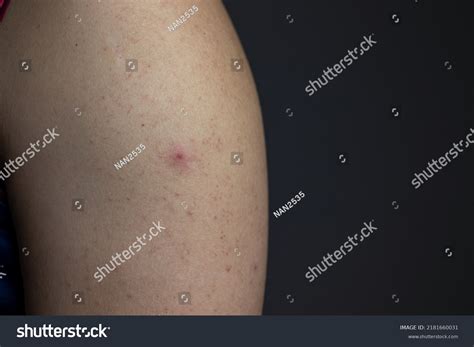 Body Acne Upper Arms At Drew Armistead Blog