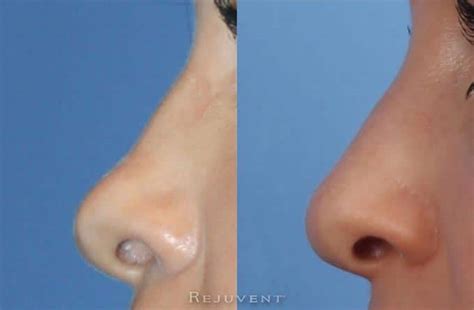Non Surgical Nose Sculpting Photos • Rejuvent Medical Spa Scottsdale
