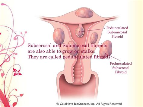 Ppt Information For Patients About Uterine Fibroid Embolization