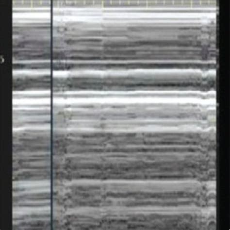 “lung Point Sign” M Mode Ultrasound A Aerated Lung Showing Seashore
