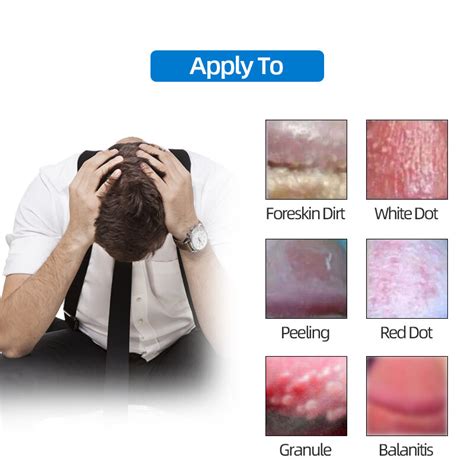 Balanitis Médica En Spray Medicina China Para El Tratamiento De Brotes