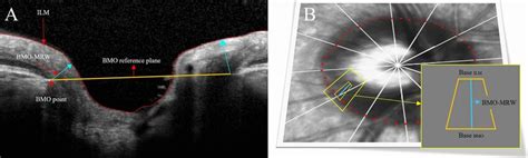 Optic Nerve Head Analysis Using Spectral Domain Optical Coherence