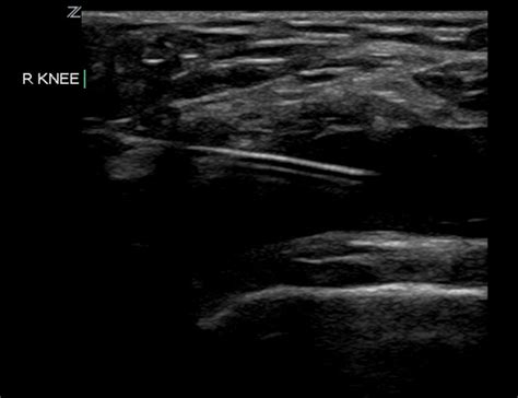 Real Time Ultrasound Guidance Used To Perform Knee Arthrocentesis