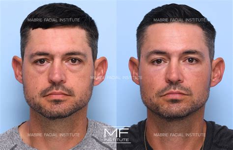 Looksmaxxing Tips How To Get Rid Of Bags Under The Eyes For Men