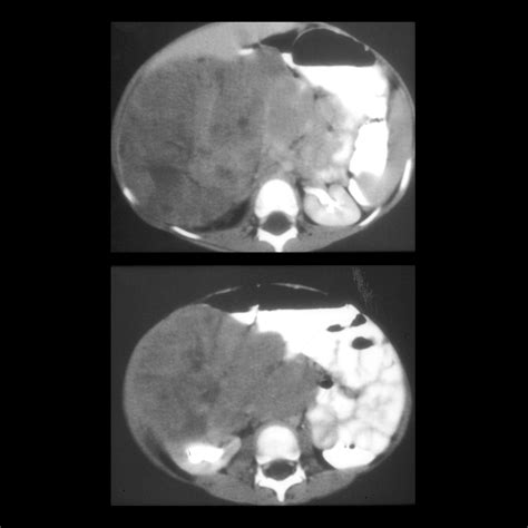 Preschooler With An Abdominal Mass Pediatric Radiology Case