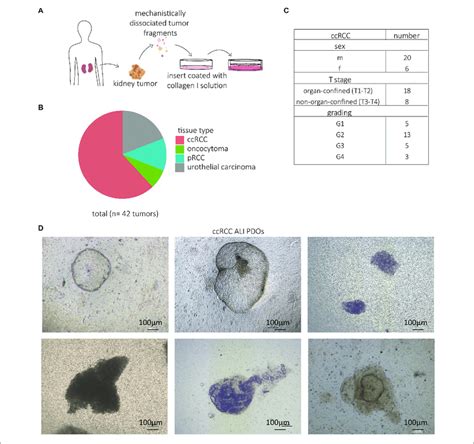 Established Ccrcc Ali Pdos Resected Tumor Tissue Was Cultivated By