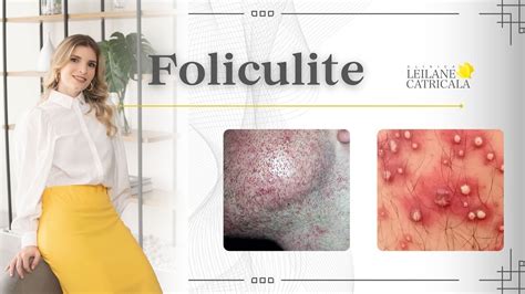 Foliculite Como Tratar Prevenir E Causas Youtube