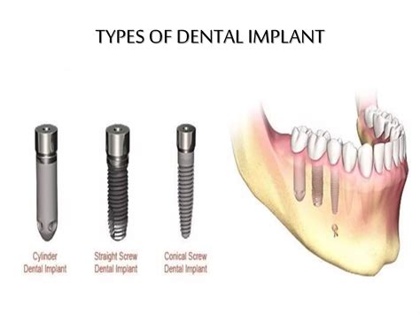 Implants Biomaterials Ppt