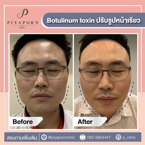 Review Botulinum Toxin ปรับรูปหน้าเรียว รูปถ่าย ใช้เป็นตัวอย่าง ผลจากการเข้ารับการรักษาพยาบาล