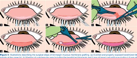 Figure 4 From A Beginner‘s Guide To Mucous Membrane Grafting For Lid