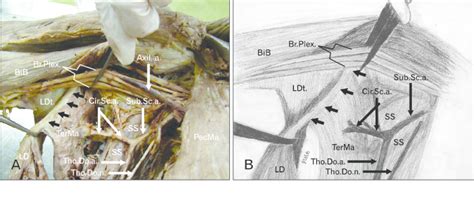 Photograph A And Schematic Drawing B Anterior Axillary Approach
