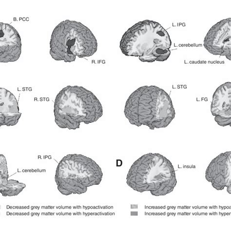 Multimodal Meta Analysis Of Structural And Functional Abnormalities In