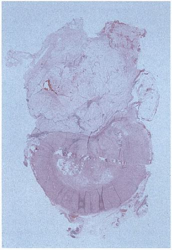 Neoplastic Appendix Abdominal Key