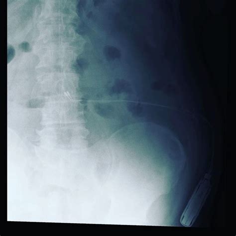 Understanding The History Of Neuromodulation And Spinal Cord Stimulation