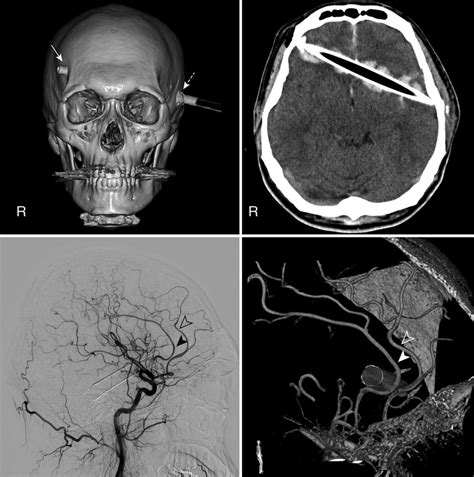 Preoperative Neuroimaging A 3d Bone Ct Reveals The Entry Arrow And Download Scientific
