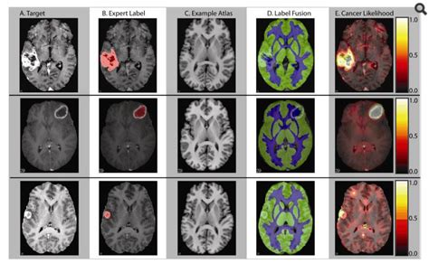Out Of Atlas Labeling A Multi Atlas Approach To Cancer Segmentation