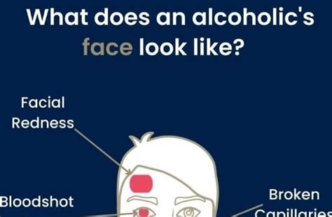 Blushing When Drinking Alcohol